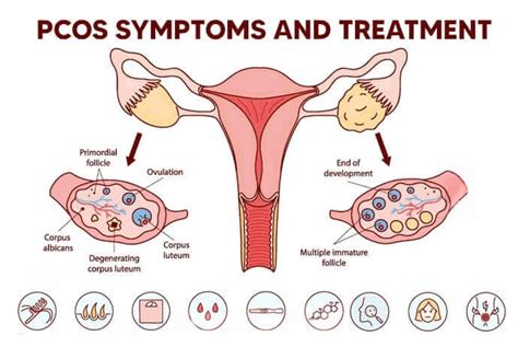 Polycystic Ovary Syndrome Pcos Pcos Symptoms Pcos Infertility