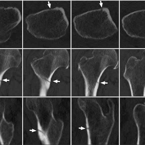 An 86 Year Old Woman A An Incomplete Fracture Line Arrows Was Download Scientific Diagram