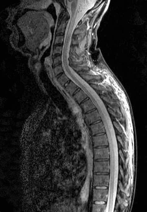 Mri Cervical Spine Sagittal Recording Stir Sequence Table Position 17 6 Download Scientific