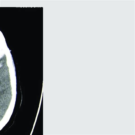 Axial Section Of Head Ct With Extensive Bilateral Subarachnoid