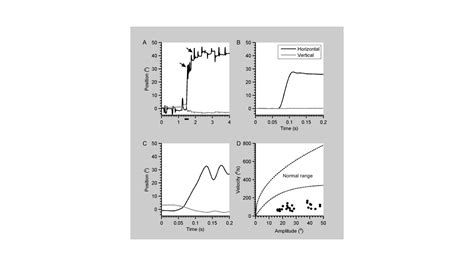 Unusual Eye Movement Found In Antineuronal Nuclear Autoantibody Type 2