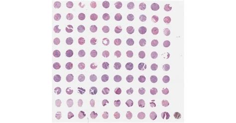 uv1001 vulval disease spectrum vulva cancer progression tissue array