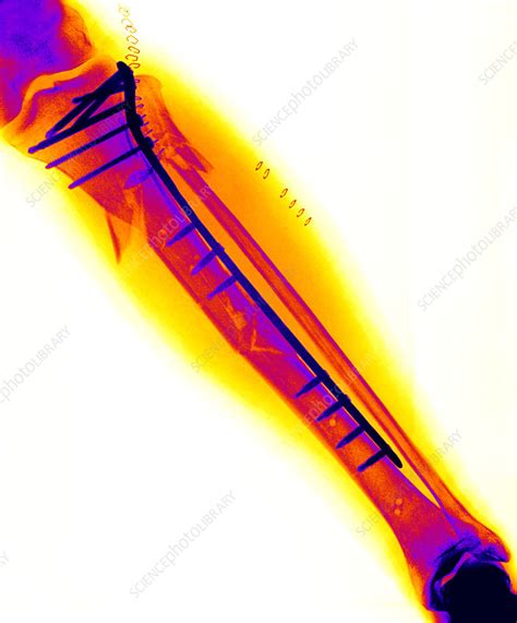 Fractured Tibia Stock Image M330 1459 Science Photo Library