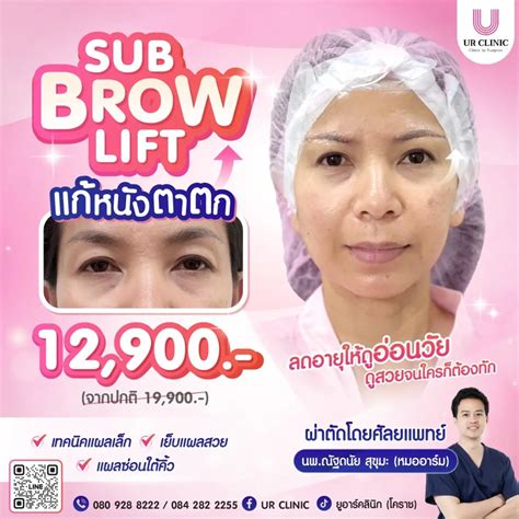 Pro Sub Brow Lift Ur Clinic