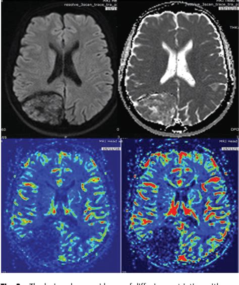 Figure 1 From Convexity Dura Based Cerebral Cavernous Malformation Mimicking Meningioma A Case