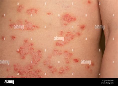 Psoriasis Skin Condition Displaying Red And Scaly Patches On The Back