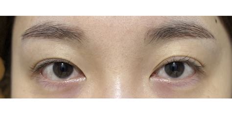 자연유착 눈매교정 인라인 후기 리얼후기 눈이 예쁘다 그래서 아몬드성형외과