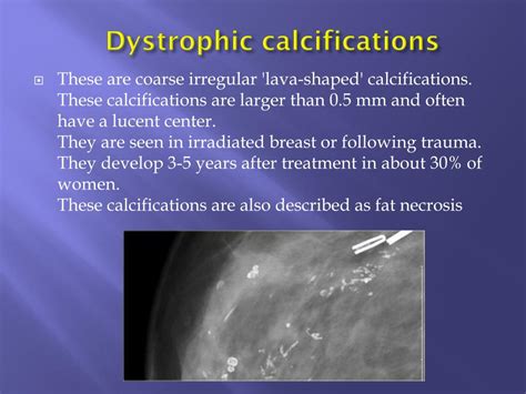 Ppt Breast Calcifications Differential Diagnosis And Birads Powerpoint Presentation Id3713492