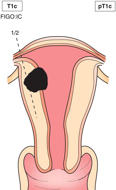 Uterine Sarcomas Leiomyosarcoma Endometrial Stromal Sarcoma Adenosarcoma Icd‐o‐3 C53 54