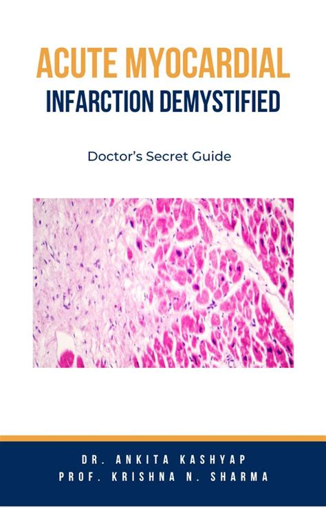 Acute Myocardial Infarction Demystified Doctors Secret Guide Ebook By Dr Ankita Kashyap