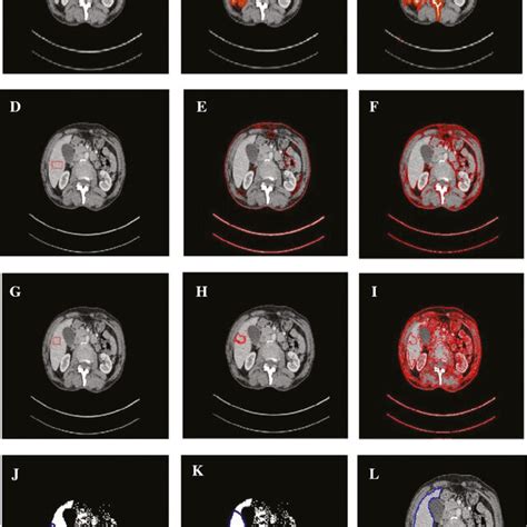 liver segmentation results comparison between proposed method and