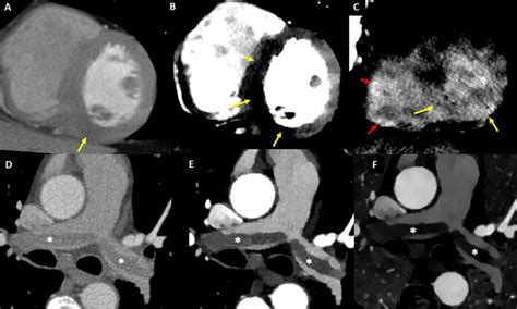 Emerging Role Of Spectral Computed Tomography In Neurocardiology Diagnóstico Journal