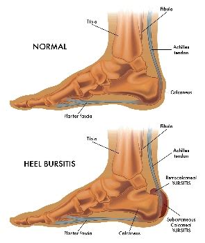 Ankle Bursa Anatomy Achilles Bursitis Retrocalcaneal Bursitis
