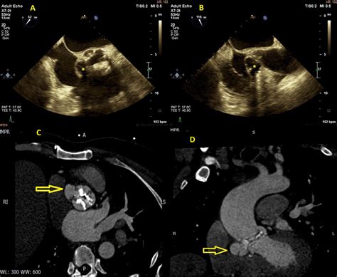 A The Echo Free Space On The Medial Side Of The Aortic Root In