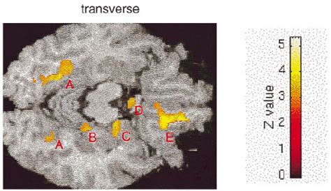 A Statistical Parametric Map Spm Of Brain Regions Which Show A