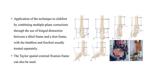 Surgical Treatment Of Ctev Pptx