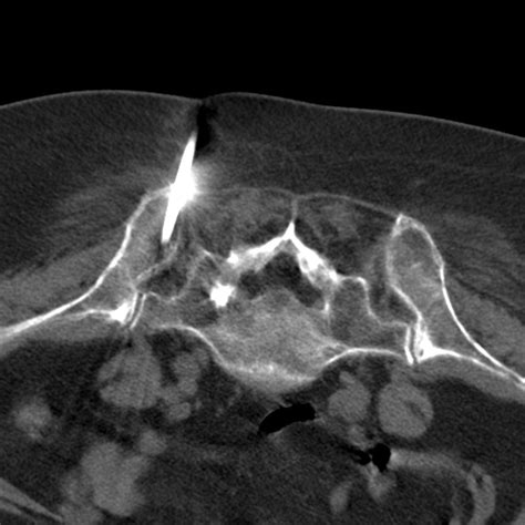 A Case Of Sarcoidosis With Multisystem Involvement Eurorad
