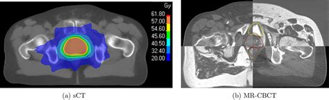 The First Patients Treated With Mr Cbct Soft Tissue Matching In A Mr
