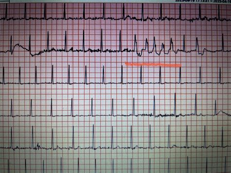 Monomorphic Nsvt Rpvcs