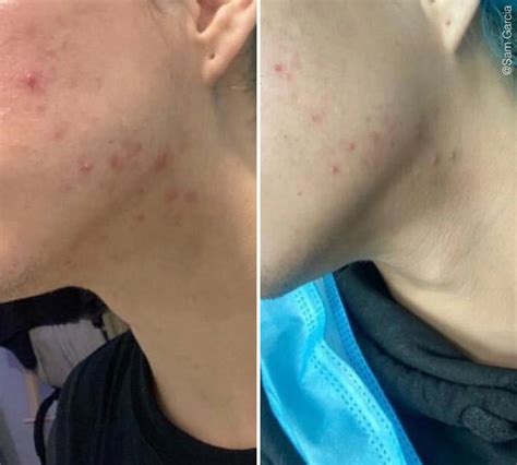 Pimple Paste Overnight Spot Treatment For Breakouts Innbeauty Project