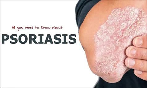 Psoriasis And Its Ayurvedic Treatment With Herbal Remedies