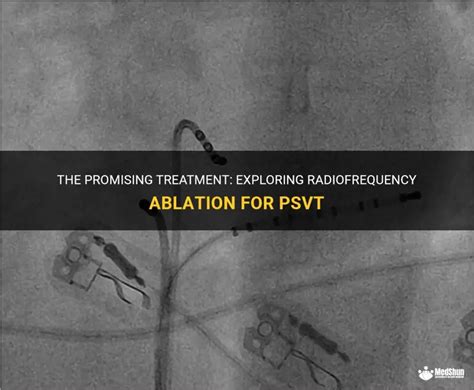 The Promising Treatment Exploring Radiofrequency Ablation For Psvt Medshun