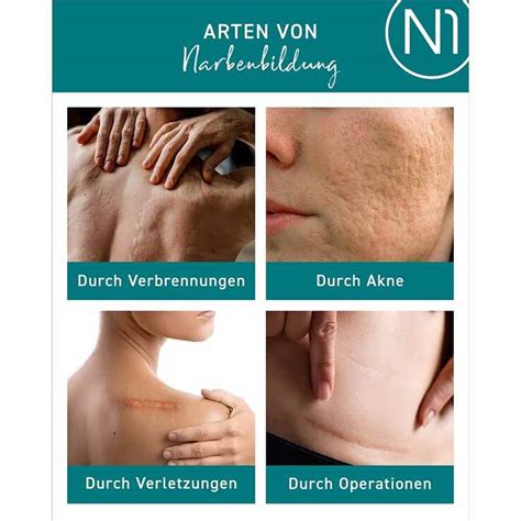 N1 Narben Gel 19 G Bei Aponeo Kaufen