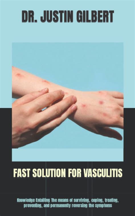 Fast Solution For Vasculitis Knowledge Entailing The Means Of
