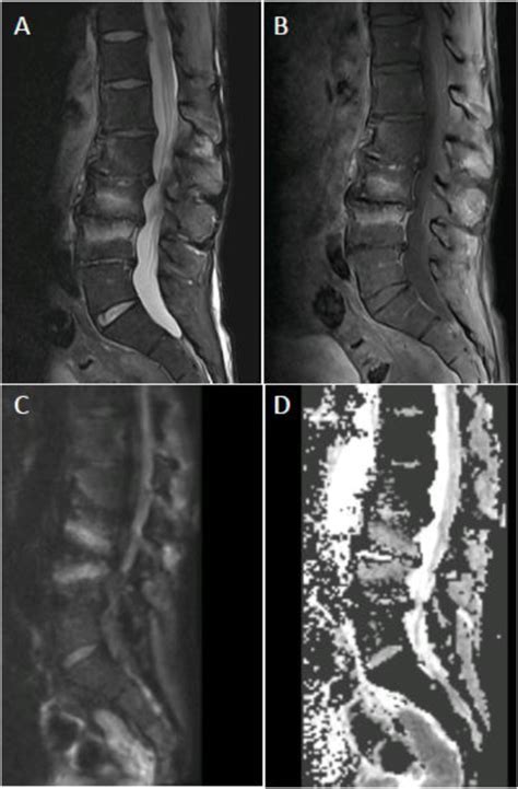 Imaging Based Approach To Extradural Infections Of The Spine Pmc