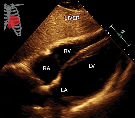 Transthoracic Echocardiography Beginners Guide With Emphasis On Blind