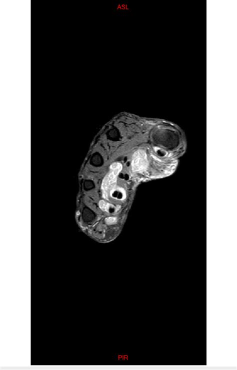 Axial Pd Fat Sat Weighted Image At The Level Of The Metacarpal Heads Download Scientific