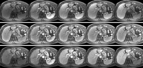 Uncorrected Upper Row Surface Coil Intensity Correction Scic