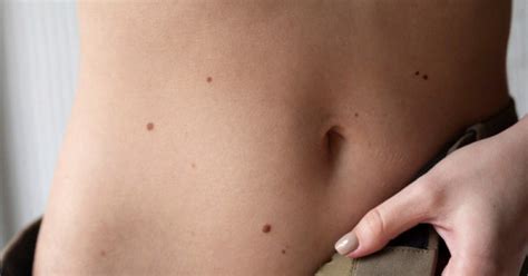 Как и почему появляются родинки на теле