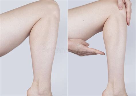 Obesity Cellulite Sagging Flabby Skin On Woman Leg Fat Before And After Concept Losing Weight