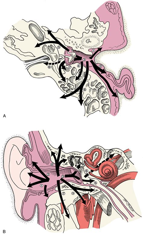 Resection Of The Temporal Bone Clinical Tree