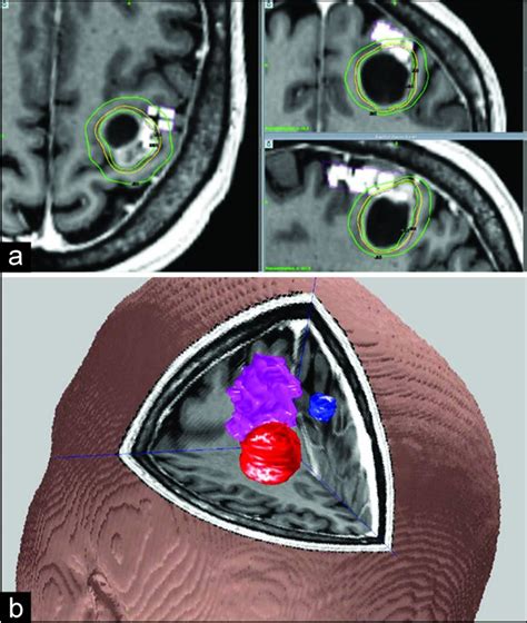 Integrating Navigated Transcranial Magnetic Stimulation Motor Mapping In Hypofractionated And