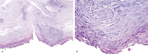 Incidental Granular Parakeratotic Cornification In Carcinoma The