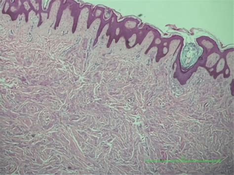 Granular Cells Infiltrating The Upper Dermis Associated With Focal