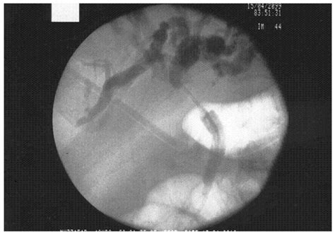Initial Cholangiogram During Endoscopic Retrograde Download