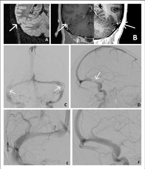 Figure 1 From Venous Sinus Stenting As A Treatment Approach In Patients