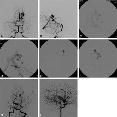 Case 4 Onyx Cast At The End Of The Procedure Dsa Unsubtracted Image