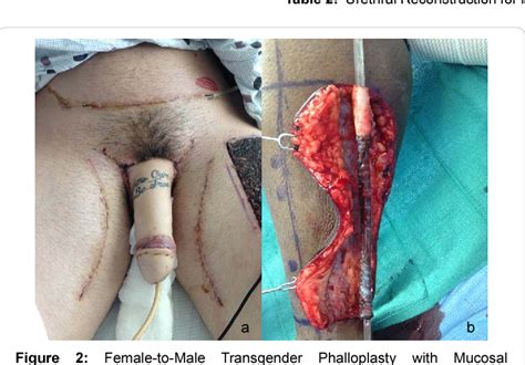 Successful Phalloplasty Penile Reconstruction Current Thoughts