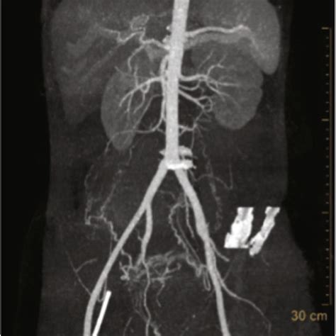 Initial Ct Angiography Demonstrating Active Extravasation Of Contrast Download Scientific