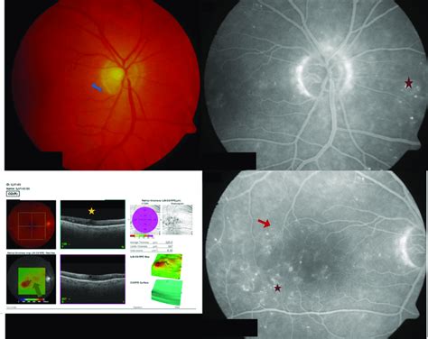 A Case From A Patient With Moderate Npdr At Screening Image Notes 1