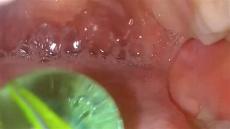 Exploration Of Stomach Marbles With Pillcam 1080hd Nicoletta Embassi