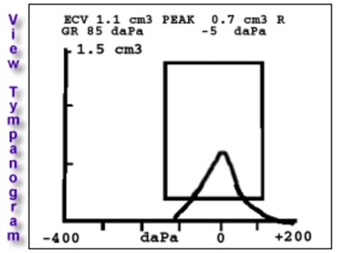 Tympanometry Department Of Pediatrics Uwmadison