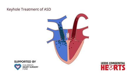 Asd Heart