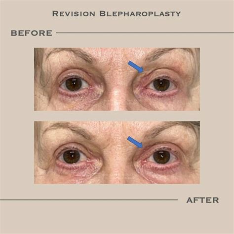 Revision Blepharoplasty Westchester Revision Eyelid Surgery In West