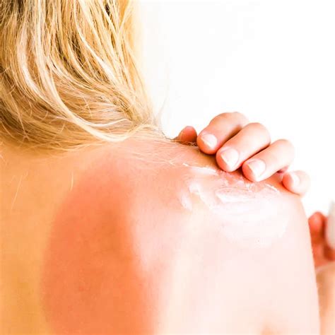 سوختگی علل بروز، نشانه ها، روش تشخیص و درمان