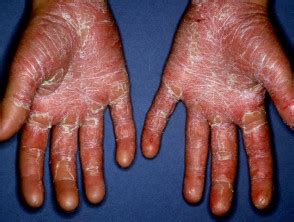 Pityriasis Rubra Pilaris Die Seite Für Ihre Haut
